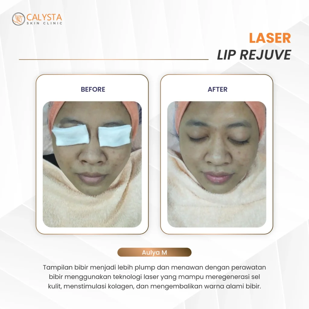 Laser Lip Rejuve - Calysta Skin Clinic